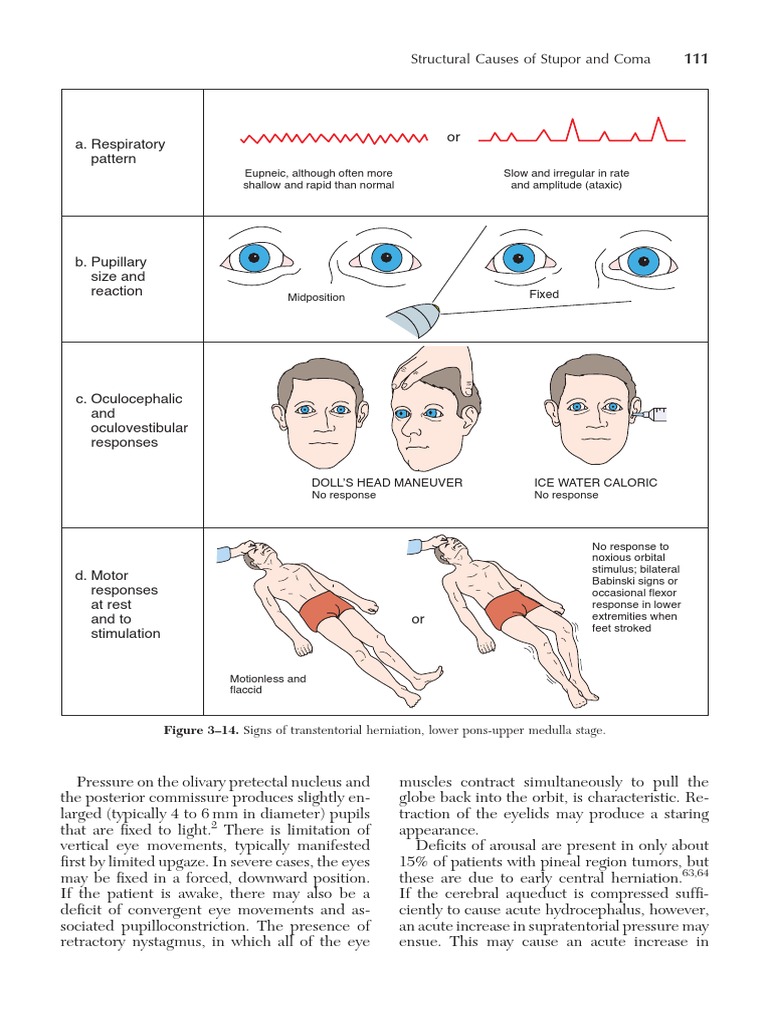 Diagnosis of Stupor and Coma 1 250 126 250 | PDF