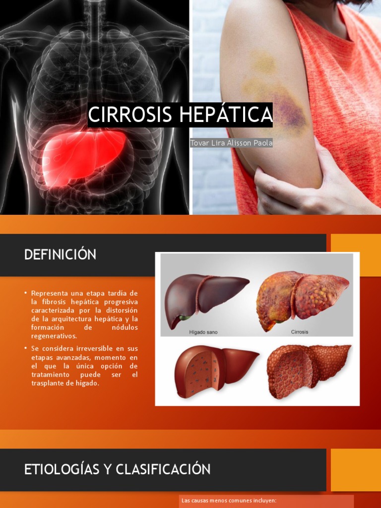 CIRROSIS HEPÁTICA | PDF | Cirrosis | Hepatitis