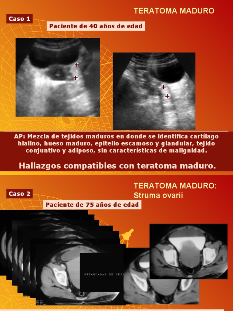 Diagnóstico de Teratoma Maduro en Pacientes | PDF