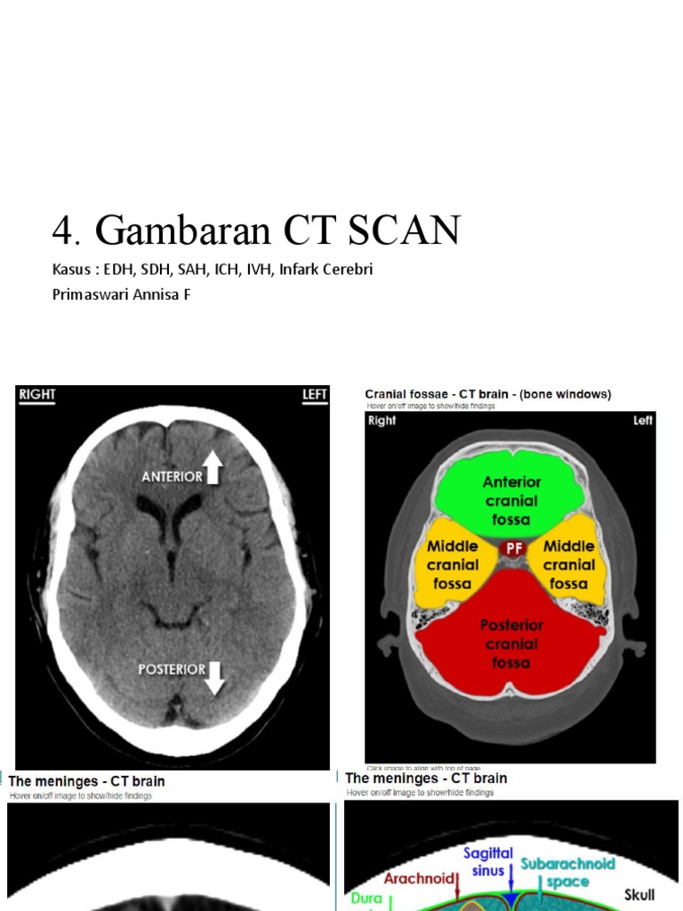 Gambaran CT EDH SDH SAH ICH IVH CI | PDF | Human Head And Neck ...