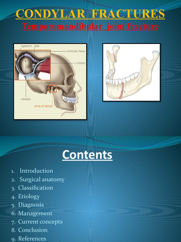 Condylar Fracture 3 | PDF | Clinical Medicine | Musculoskeletal System