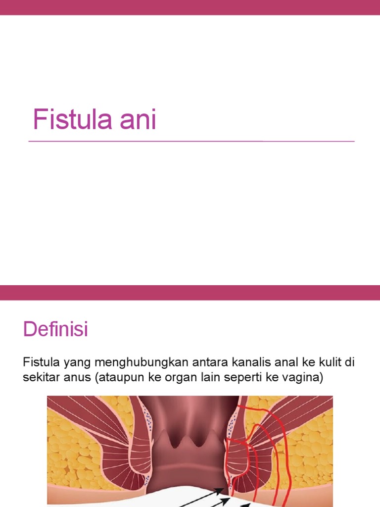 Fistula Ani | PDF