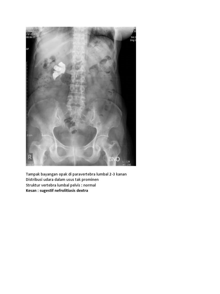 Hasil Rontgen Nefrolitiasis Dextra | PDF