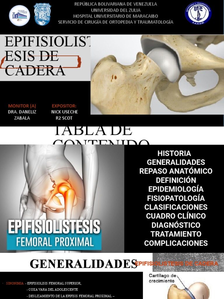 Epifisiolistesis de Cadera | PDF | Rodilla | Sistema musculoesquelético