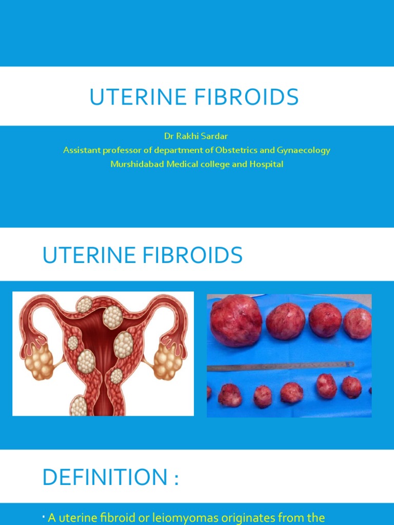 Uterine Fibroids | Download Free PDF | Gynaecology | Human Reproduction