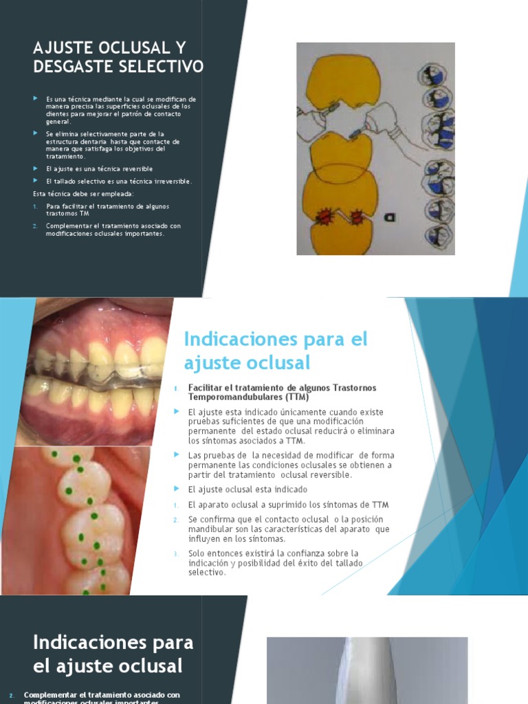 Ajuste Oclusal y Desgaste Selectivo | PDF | Ortodoncia | Esmalte de dientes