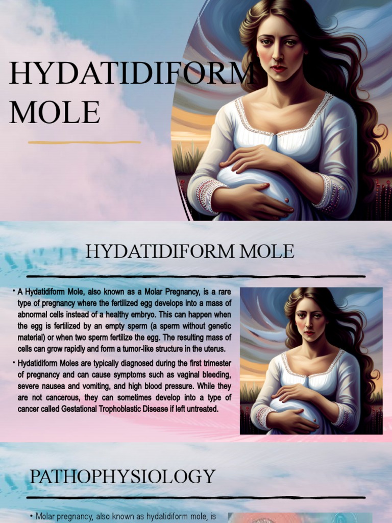 Hydatidiform Mole | PDF
