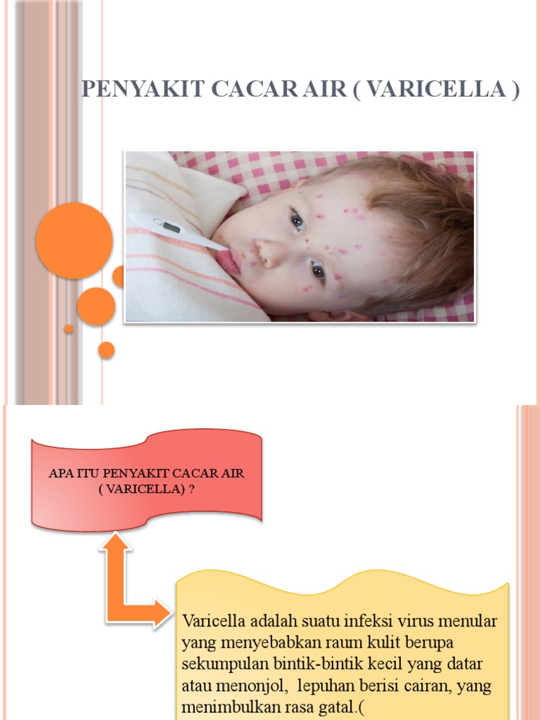Penyakit Cacar Air (Varicella) | PDF