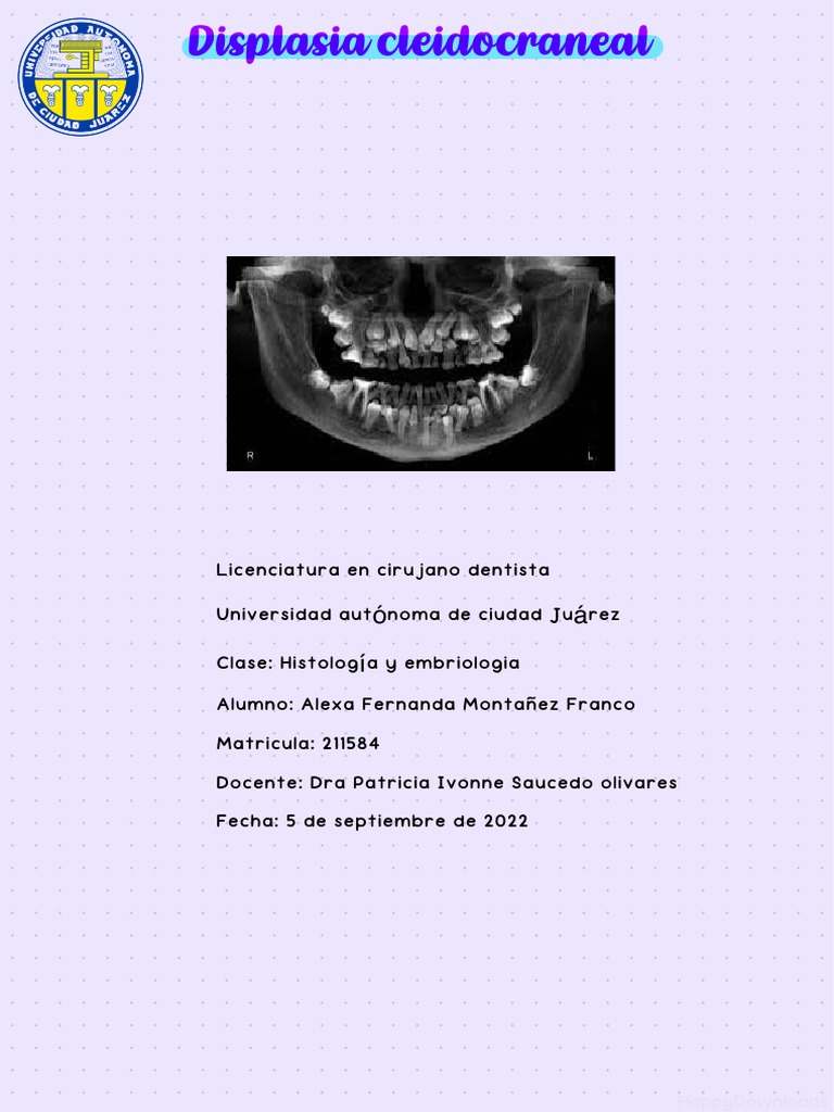 Displasia Cleidocraneal: Características y Tratamiento | PDF ...