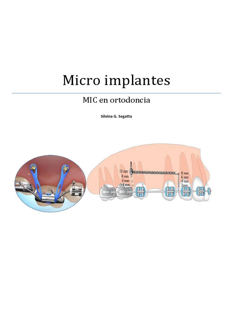 Microimplantes en Ortodoncia: Anclaje Eficaz | PDF | Hueso | Ramas de ...