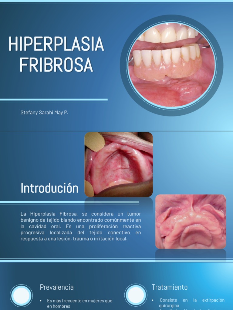 Hiperplasia Fibrosa en Cavidad Oral | PDF | Causas de la muerte ...