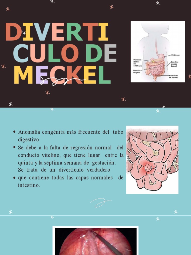Diverticulo de Meckel | PDF | Medicina CLINICA | Especialidades Medicas
