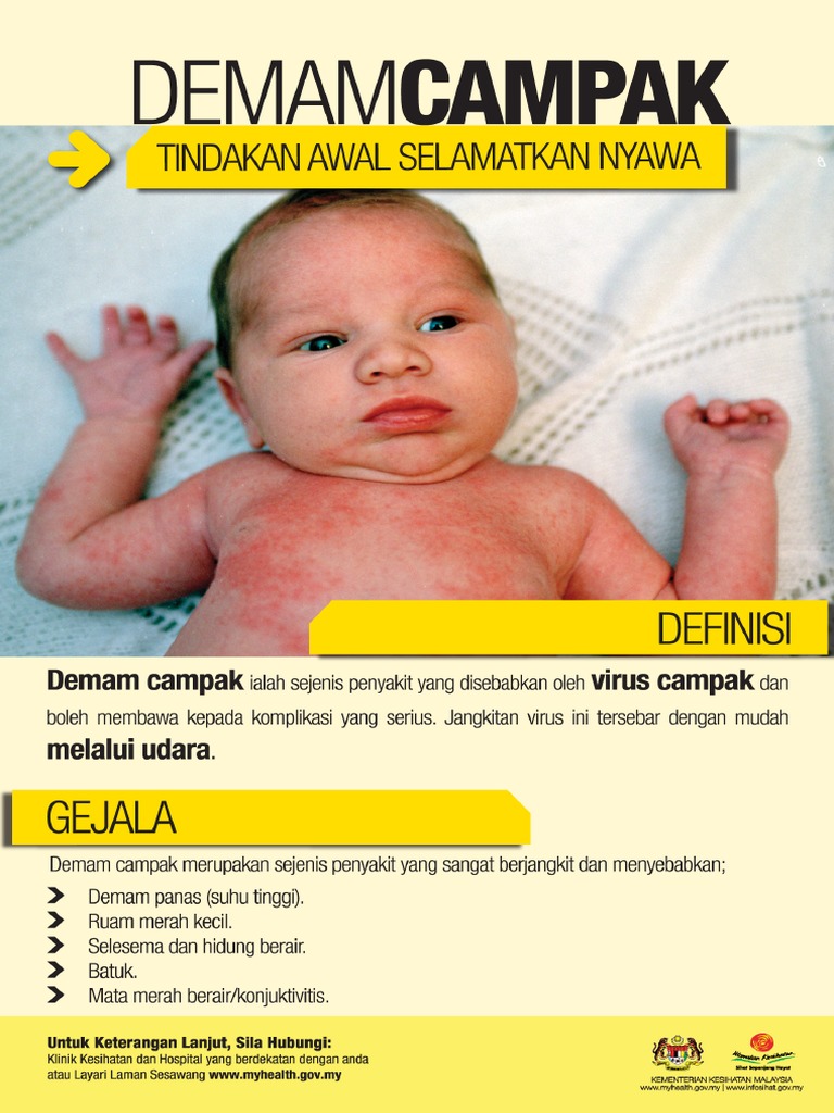 32 Campak | PDF