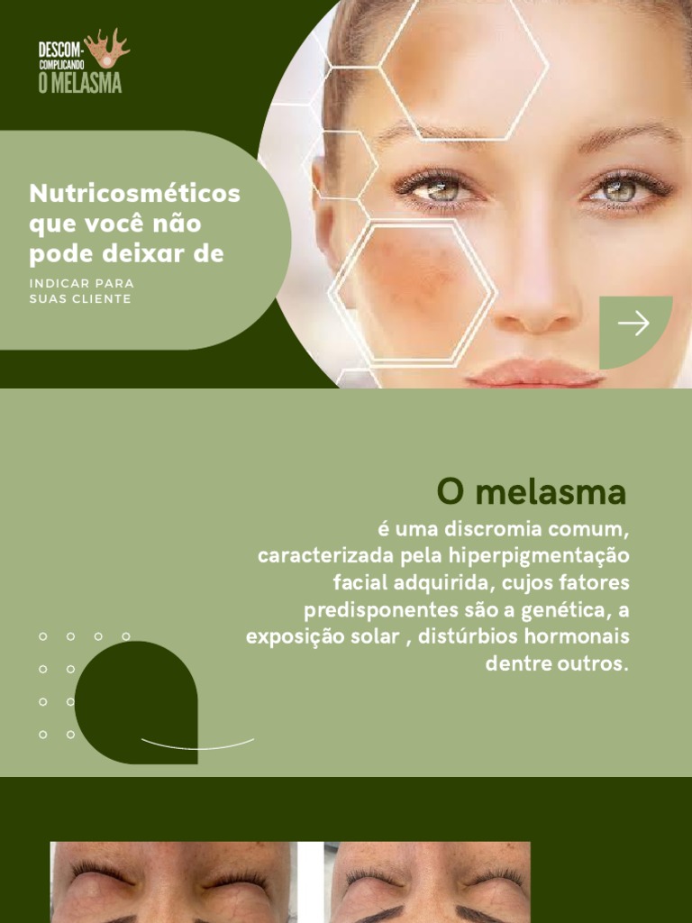 Descomplicando o Melasma - Aula 2 | PDF | Vitamina | Antioxidante