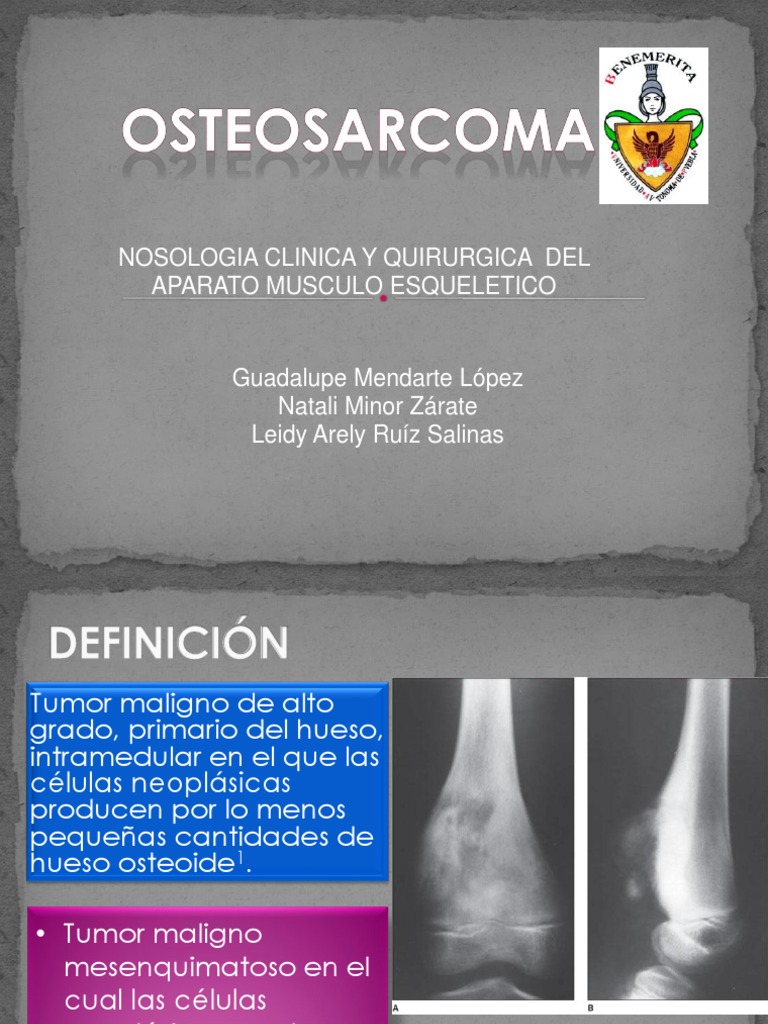 Osteosarcoma | PDF | Hueso | Biopsia