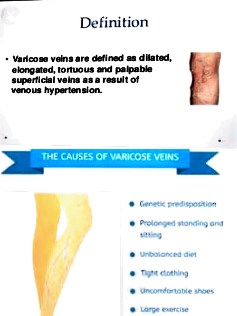 Varicose Veins | PDF | Varicose Veins | Vein
