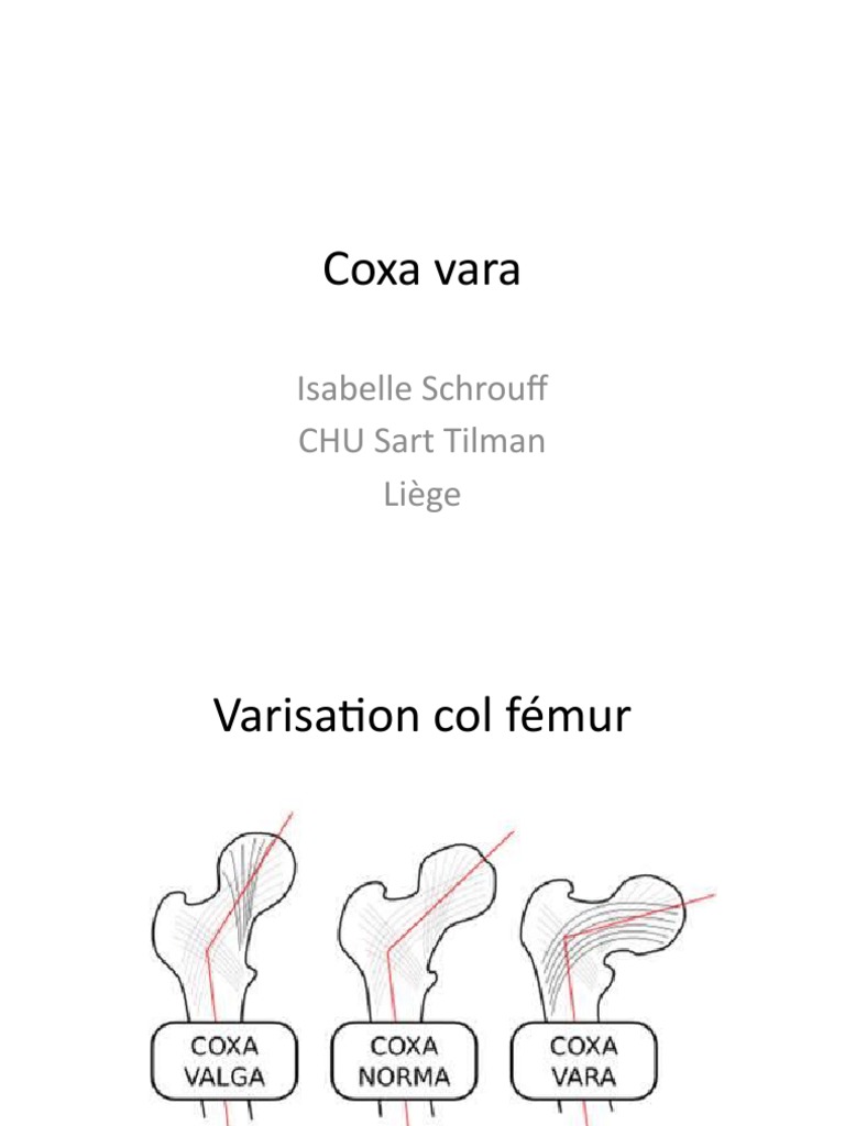 Coxa Vara | PDF | Os | Trouble musculosquelettique
