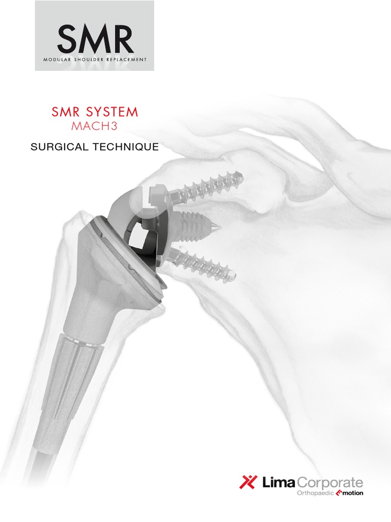 SMR - Mach 3 - Completo | Download Free PDF | Shoulder | Surgery