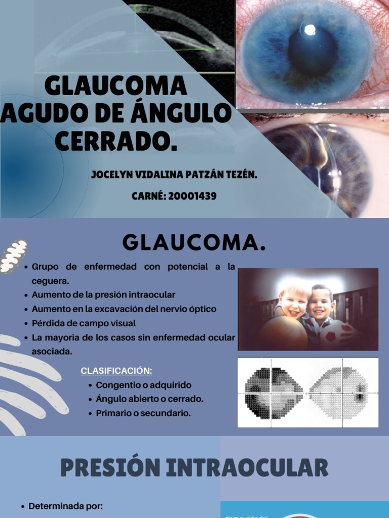 Glaucoma Agudo de Ángulo Cerrado | Descargar gratis PDF | Glaucoma | Enfermedades y trastornos