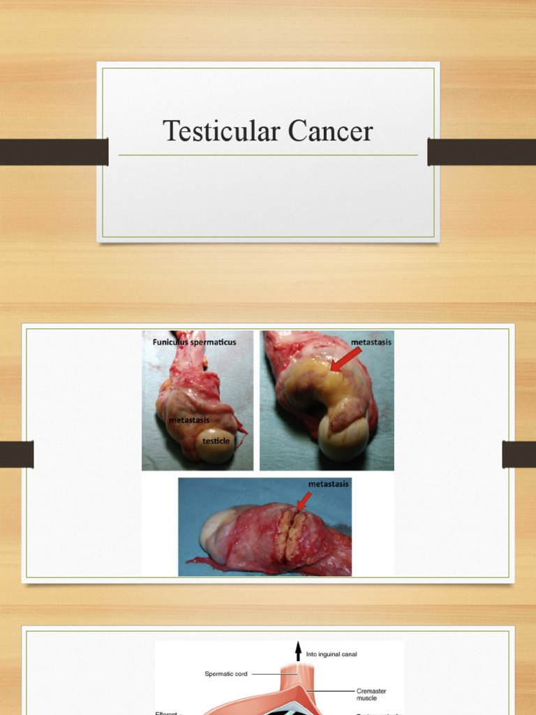 Testicular Cancer | PDF | Testicle | Cancer