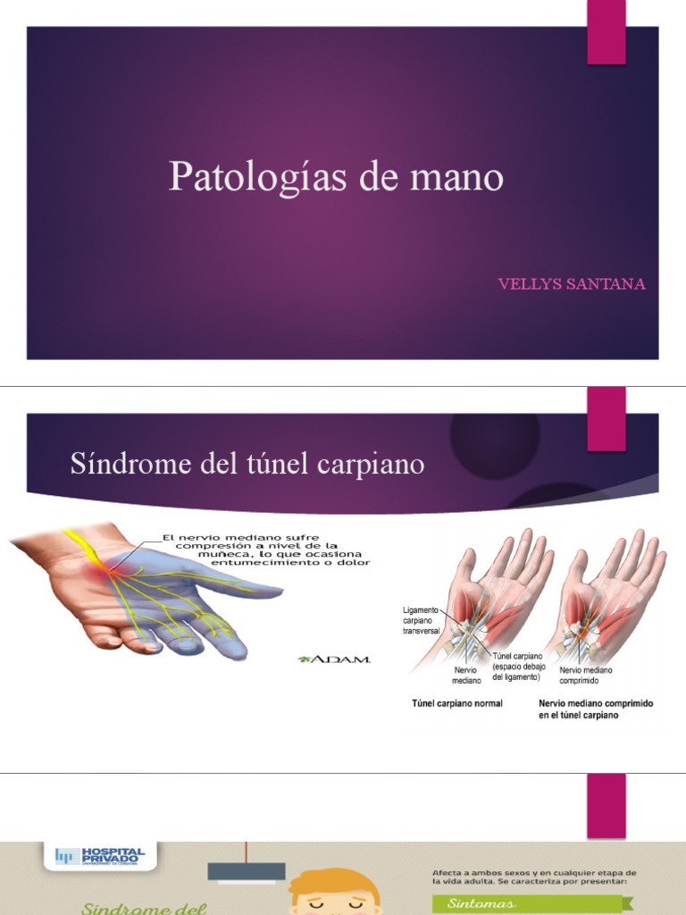Patologías de Mano | PDF | Síndrome del túnel carpiano | Mano