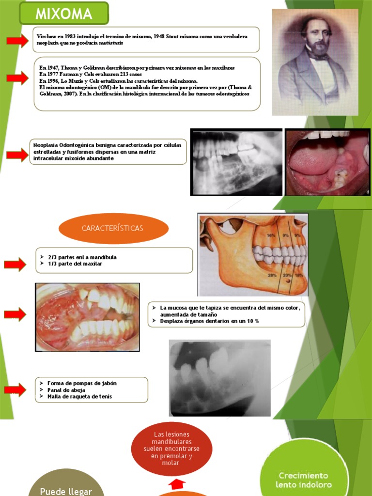 Mixoma Odontogénico: Diagnóstico y Tratamiento | PDF