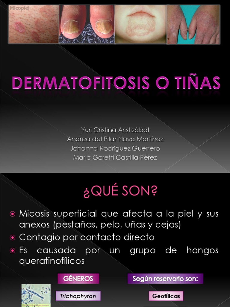 Dermatofitosis o Tiñas | Medicina | Dermatología