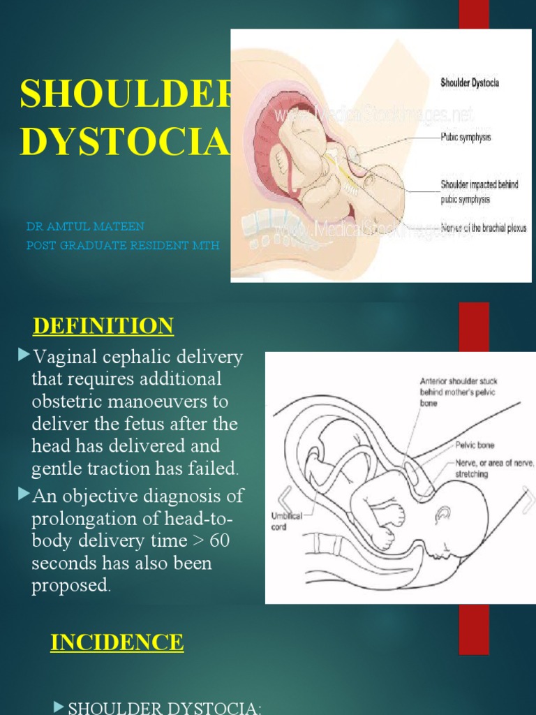 SHOULDER DYSTOCIA Presentation | PDF | Childbirth | Gestational Diabetes