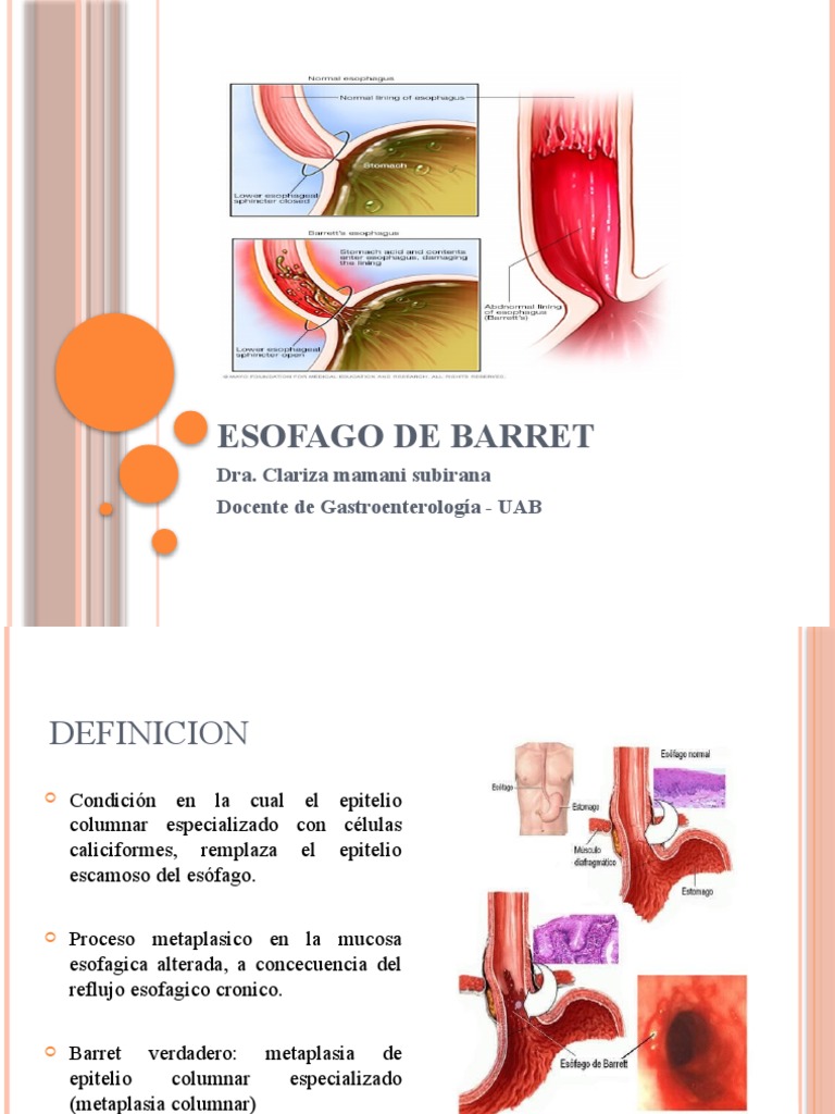1 - Esofago de Barret2 | PDF | La enfermedad por reflujo ...