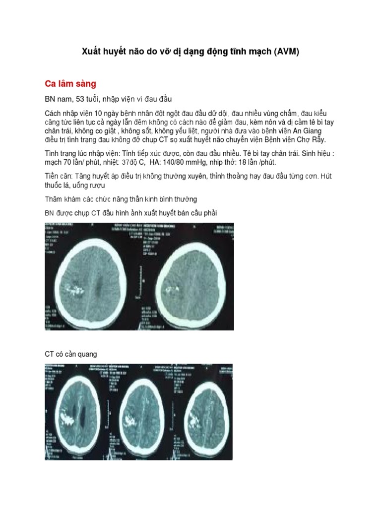 Xuat Huyet Nao Do Vo Di Dang Dong Tinh Mach 2 | PDF