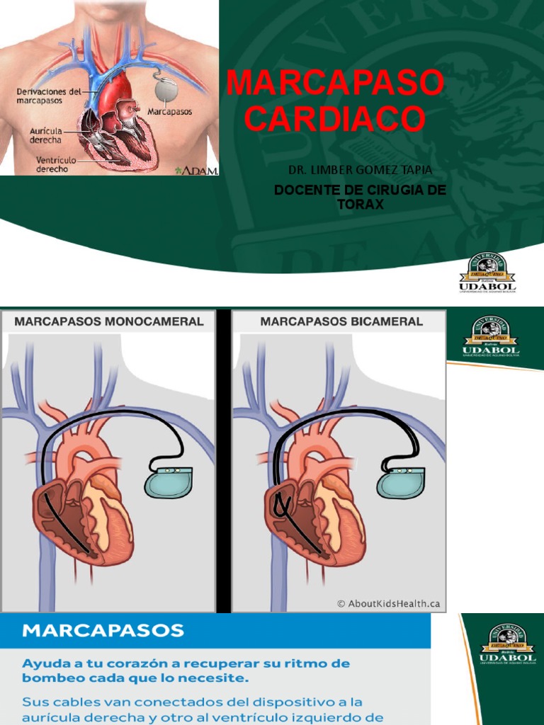 Marcapaso Cardiaco | PDF | Marcapasos cardíacos artificiales | Medicina CLINICA