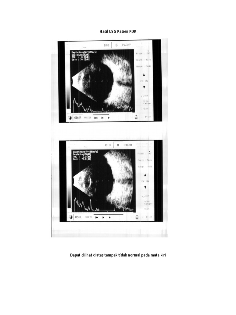 Hasil USG Pasien PDR | PDF