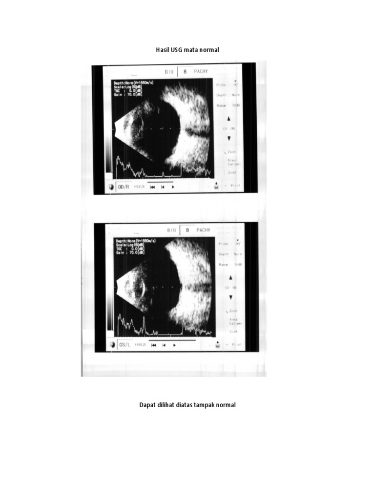 Hasil USG Mata Normal | PDF