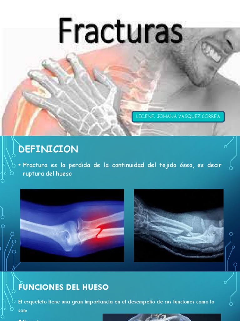 Fracturas 1 | Descargar gratis PDF | Hueso | Medicina CLINICA