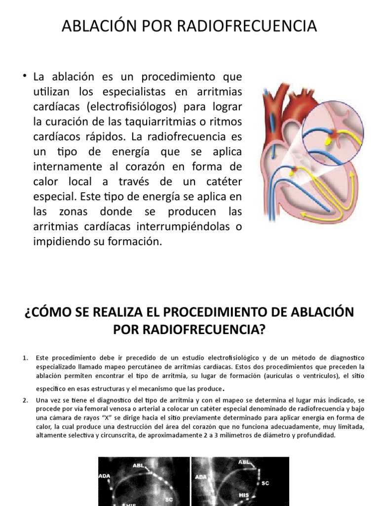 Ablación Por Radiofrecuencia | PDF | Ablación | Medicina CLINICA