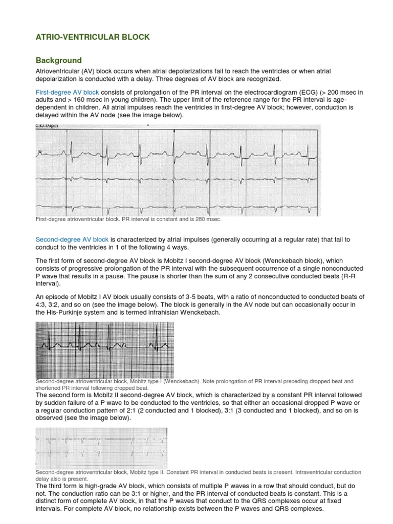 Av Block | PDF | Artificial Cardiac Pacemaker | Electrocardiography