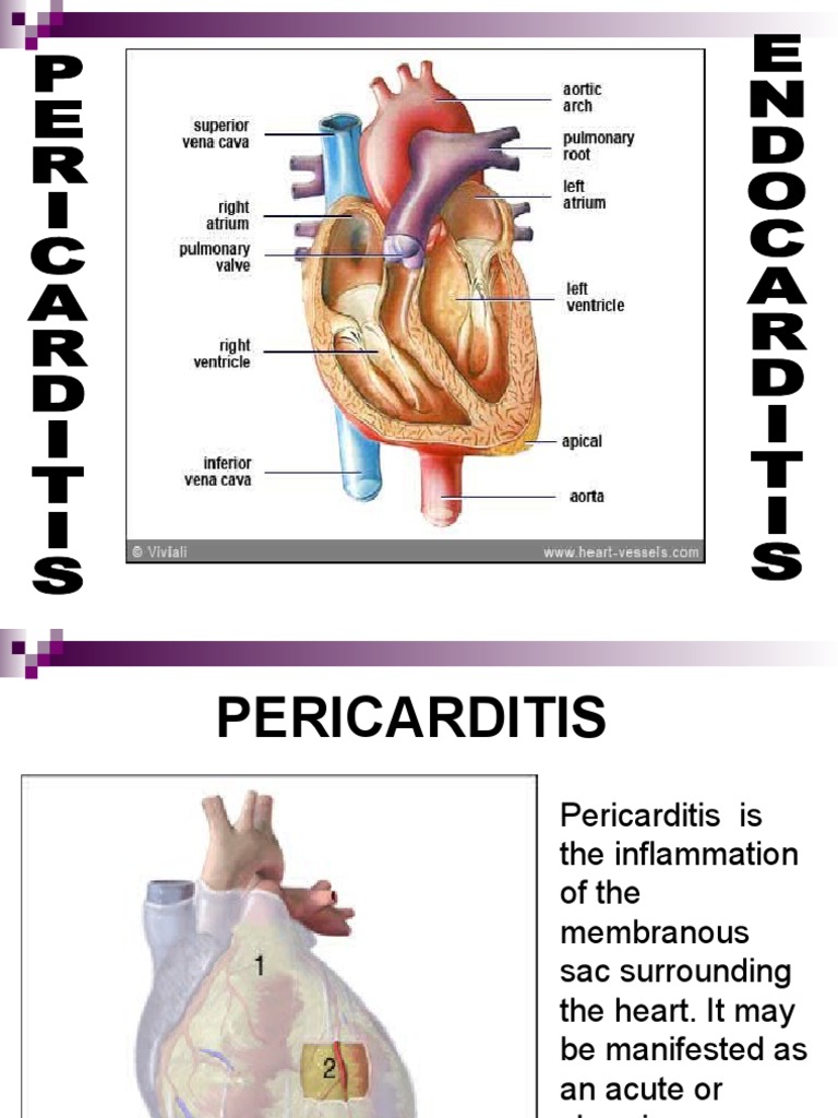 Pericarditis and Endocarditis | PDF | Internal Medicine ...