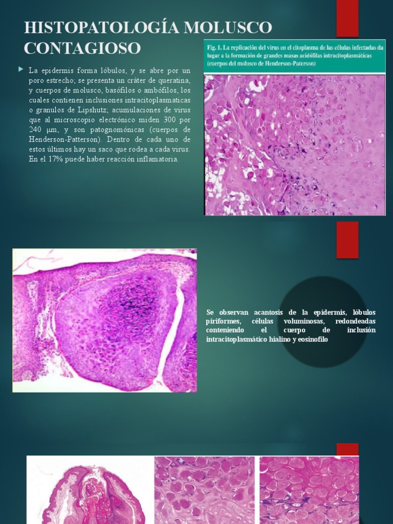 HISTOPATOLOGÍA MOLUSCO CONTAGIOSO | PDF