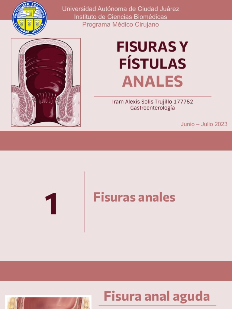 Fisura y Fístula Anal | PDF | Hemorroides | Especialidades Medicas