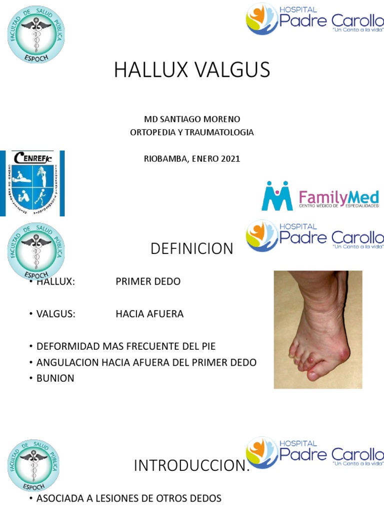 Hallux Valgus | PDF | Medicina | Especialidades Medicas