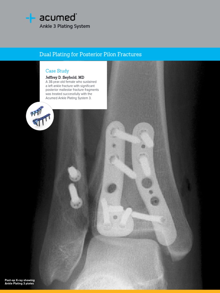 Acumed Case Study EN AP3 Dual Plating For Posterior Pilon Fractures ...