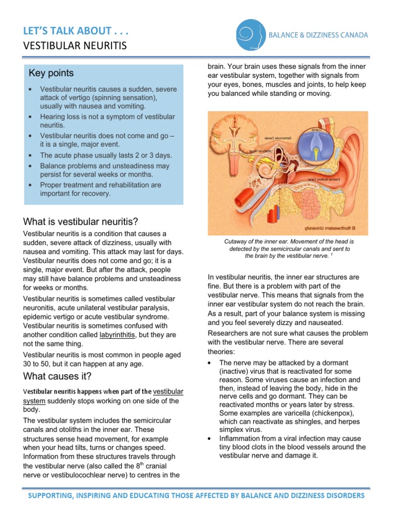 Vestibular Neuritis Handout | PDF | Vertigo | Vestibular System