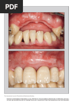 Miller Classification of Marginal Tissue | PDF | Periodontology ...