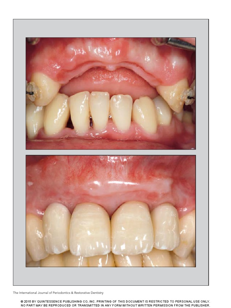 Vertical Ridge Augmentation and Soft Tissue Reconstruction of The ...