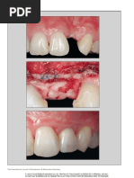 Miller Classification of Marginal Tissue | PDF | Periodontology ...