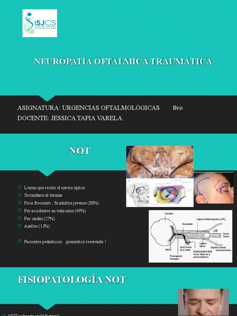 Neuropatía Oftalmica Traumática: Asignatura: Urgencias Oftalmológicas ...