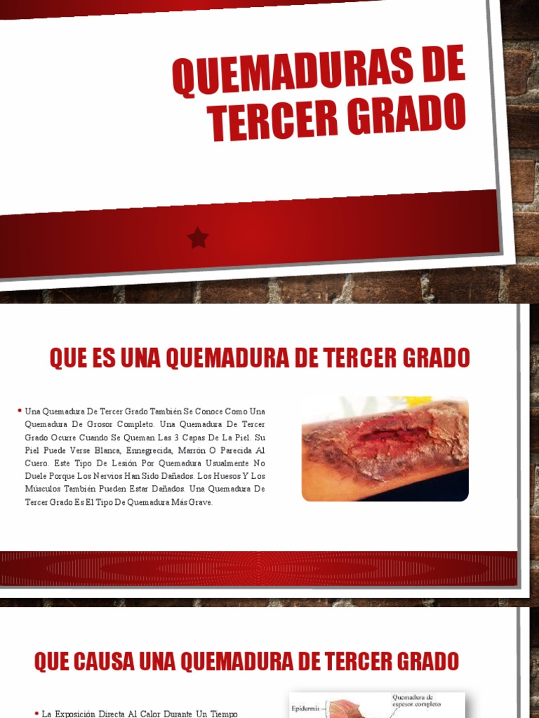 Quemaduras de Tercer Grado | PDF | Quemar | Herida