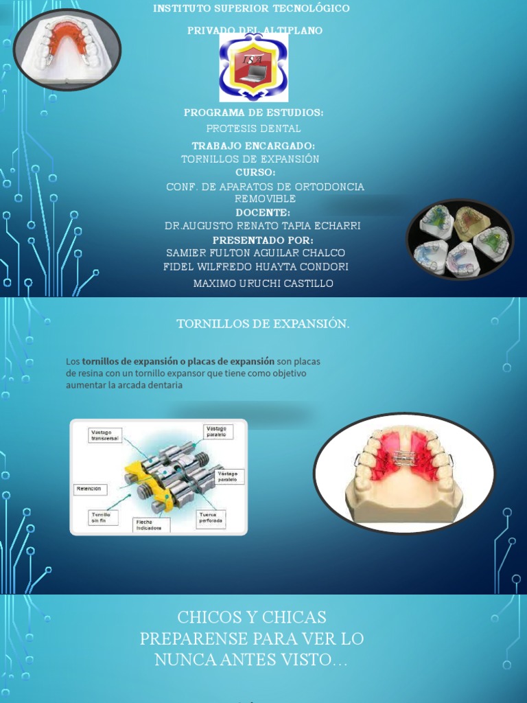 TORNILLO DE EXPANSION Ortodoncia Pediatrica | PDF | Ortodoncia ...