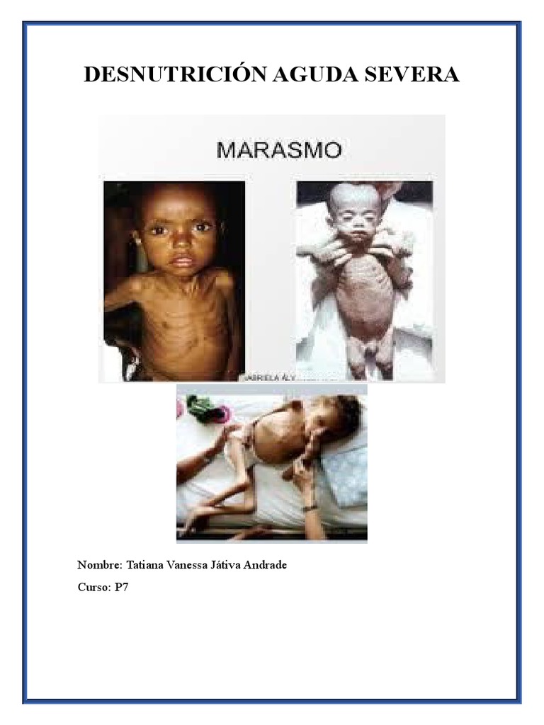 Desnutrición Aguda Severa | PDF