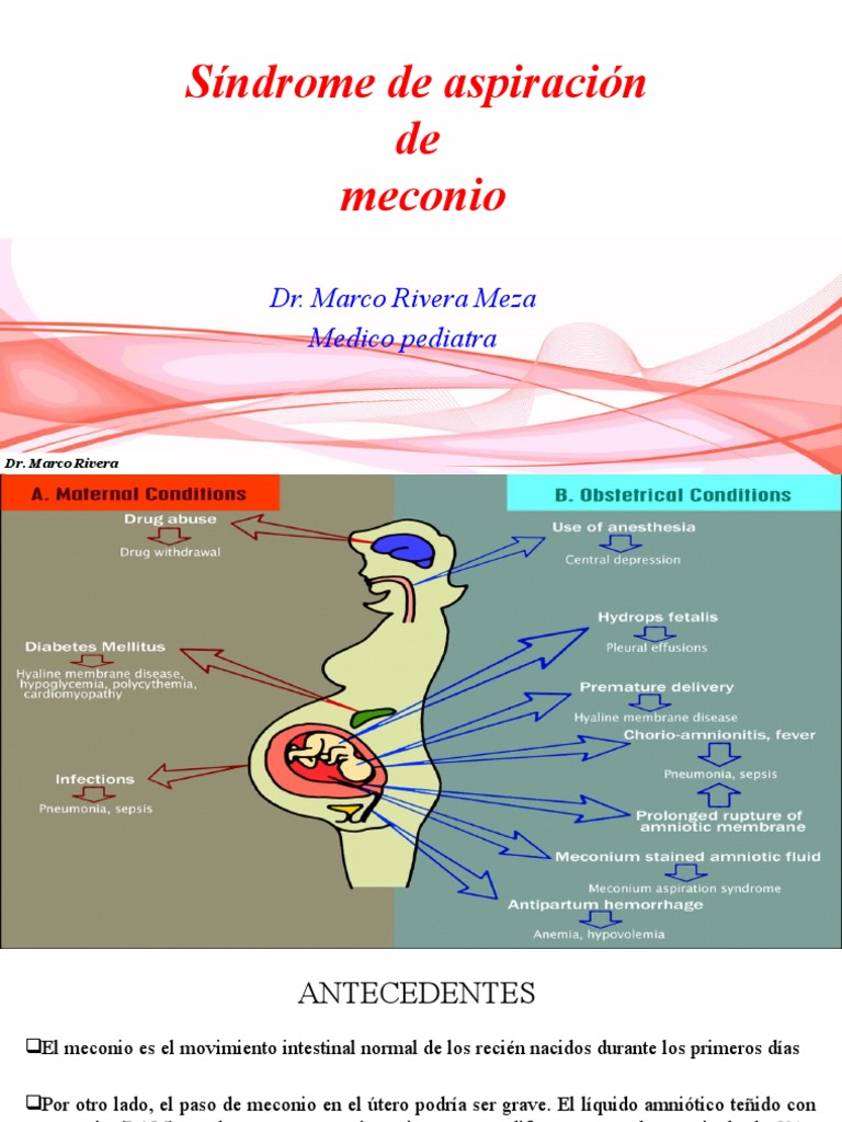 Síndrome de Aspiración de Meconio | PDF | Causas de la muerte | Medicina
